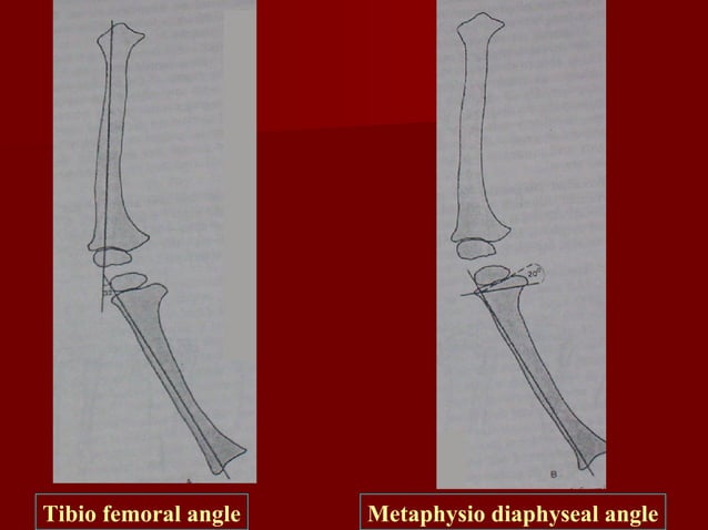 Angular & torsional deformities of the lower limb | PPT