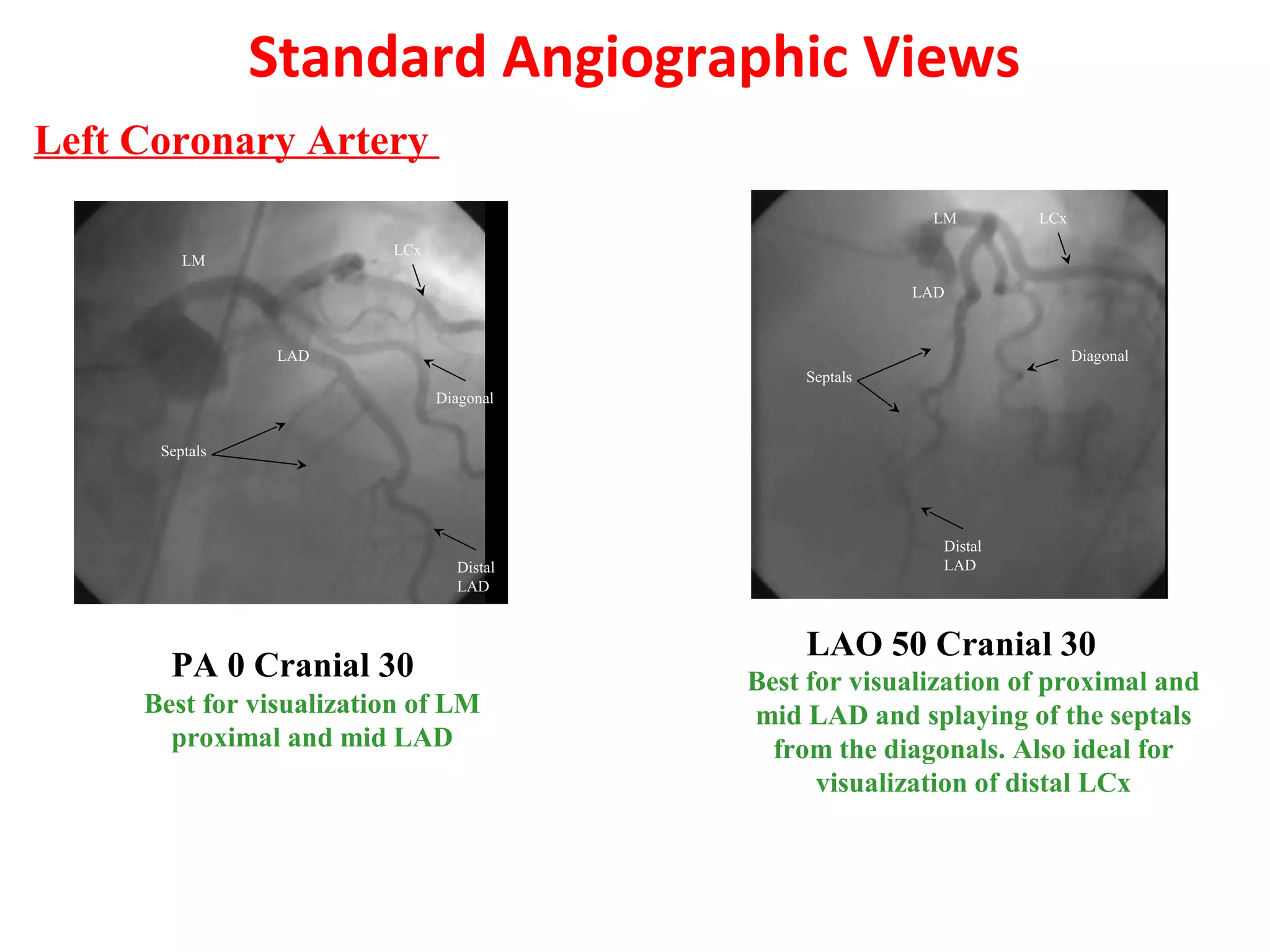 Angulated views in coronary angiography,an introductory lecture for ...
