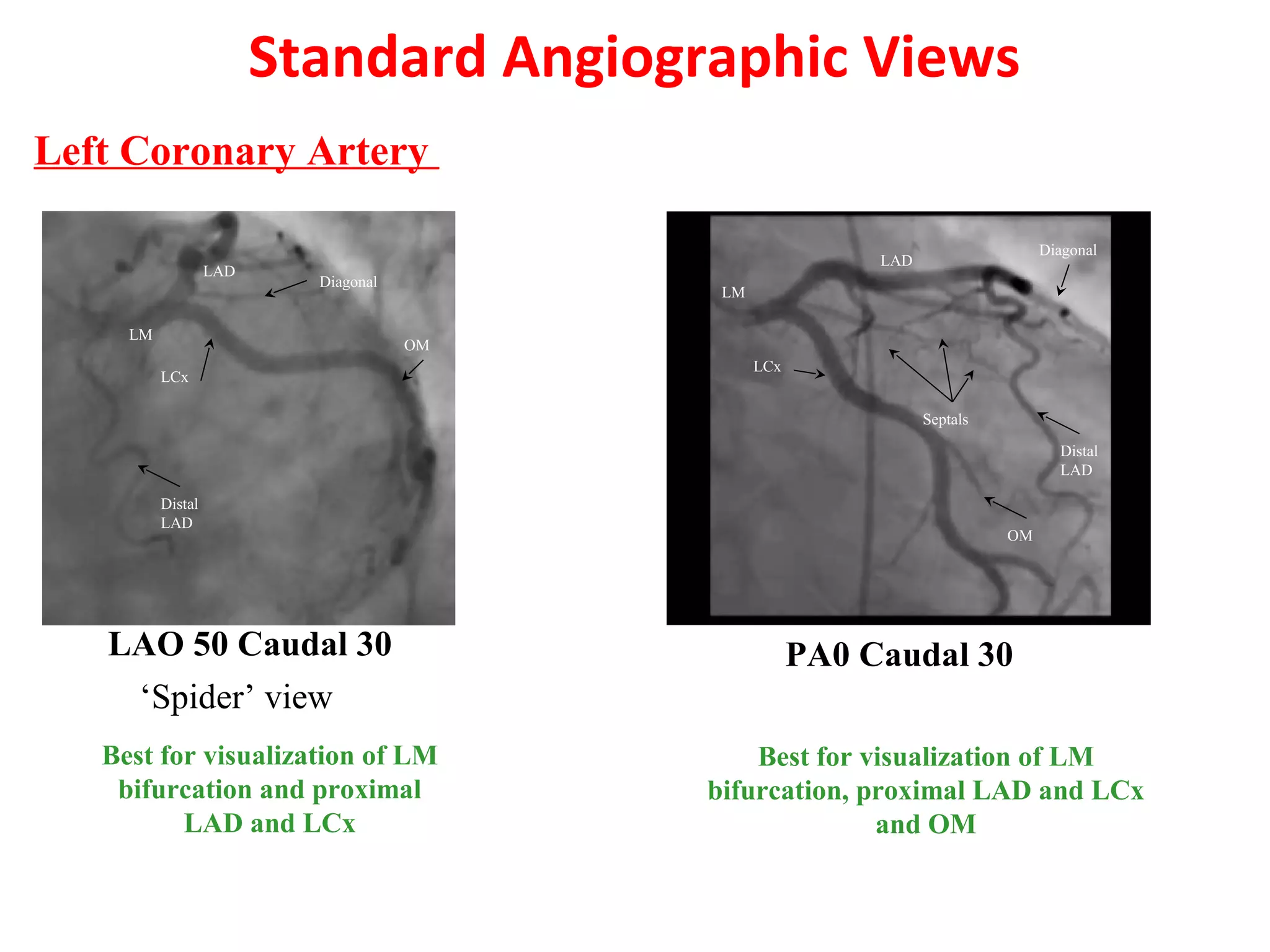 Angulated views in coronary angiography,an introductory lecture for ...