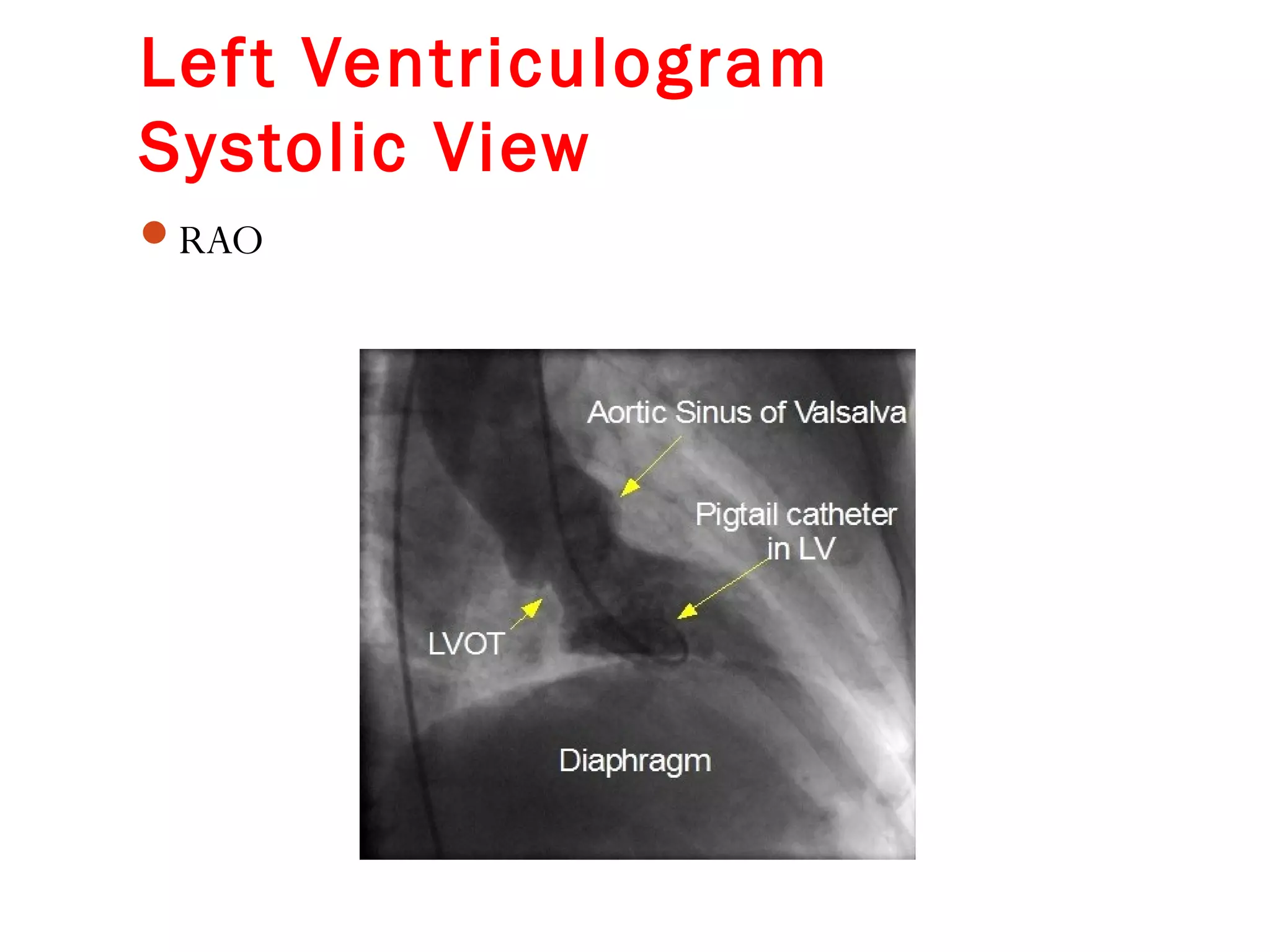 Angulated views in coronary angiography,an introductory lecture for ...