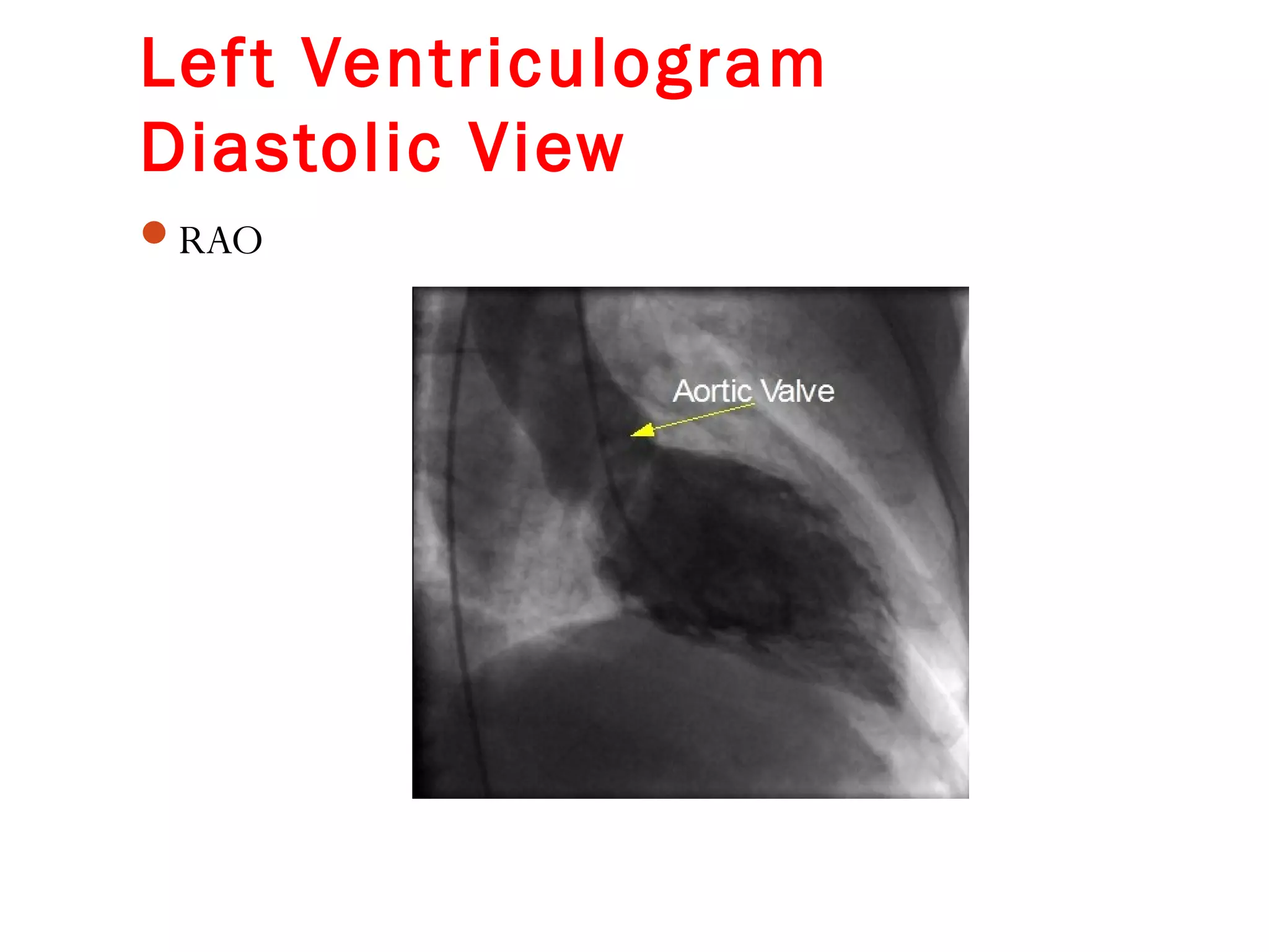 Angulated views in coronary angiography,an introductory lecture for ...