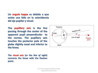 Angulo kappa en oftalmologia | PPTX