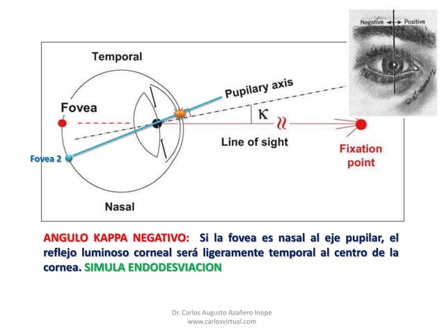 Angulo kappa en oftalmologia | PPTX