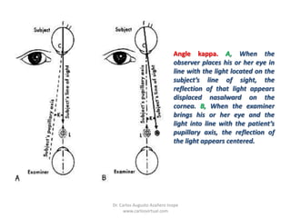 Angulo kappa en oftalmologia | PPTX
