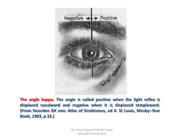 Angulo kappa en oftalmologia