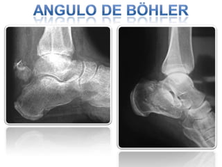 ANGULOMETRIA.ppt