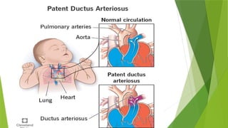 Patent ductus arteriosus Pediatric nurse | PPTX