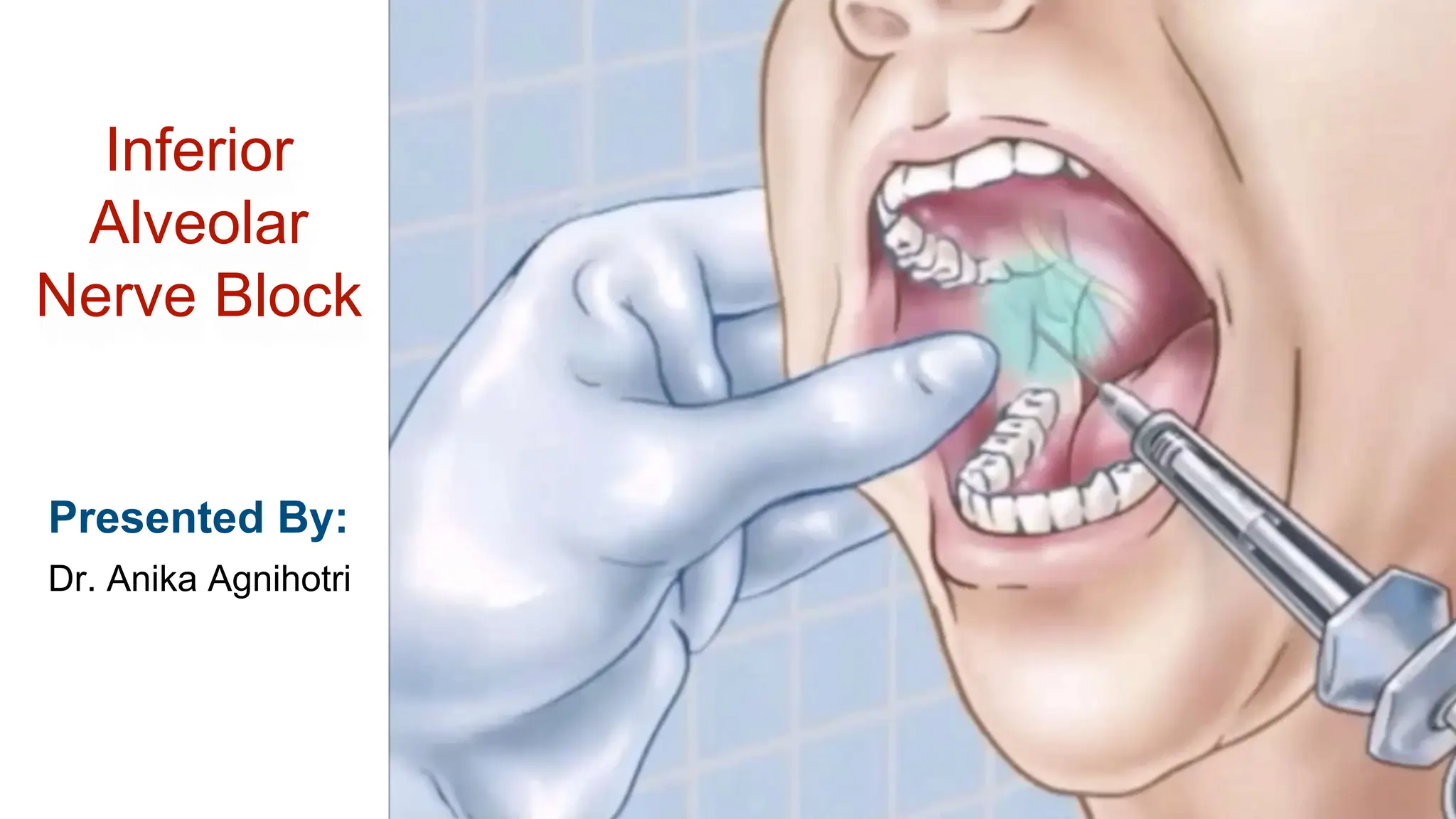 Inferior Alveolar Nerve Block Anesthetic Technique | PPT
