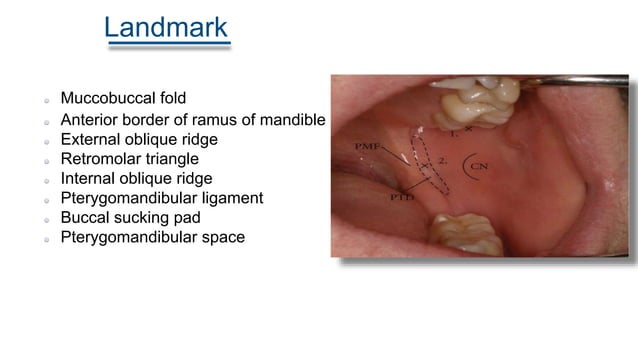 Inferior Alveolar Nerve Block Anesthetic Technique | PPTX | Ear, Nose ...