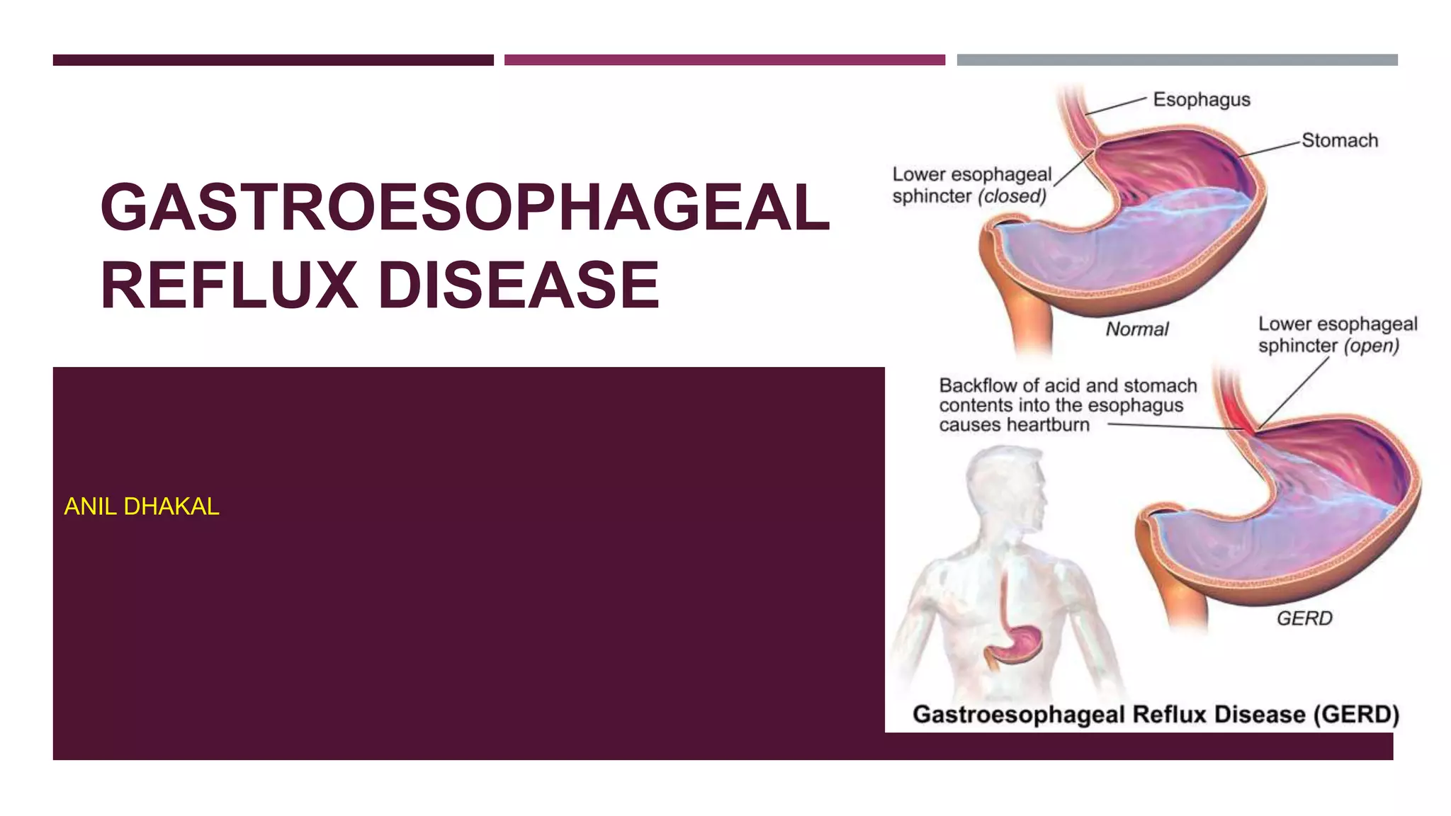 CASE STUDY GERD | PPTX