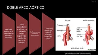 Anillos vasculares Radiología | PPTX