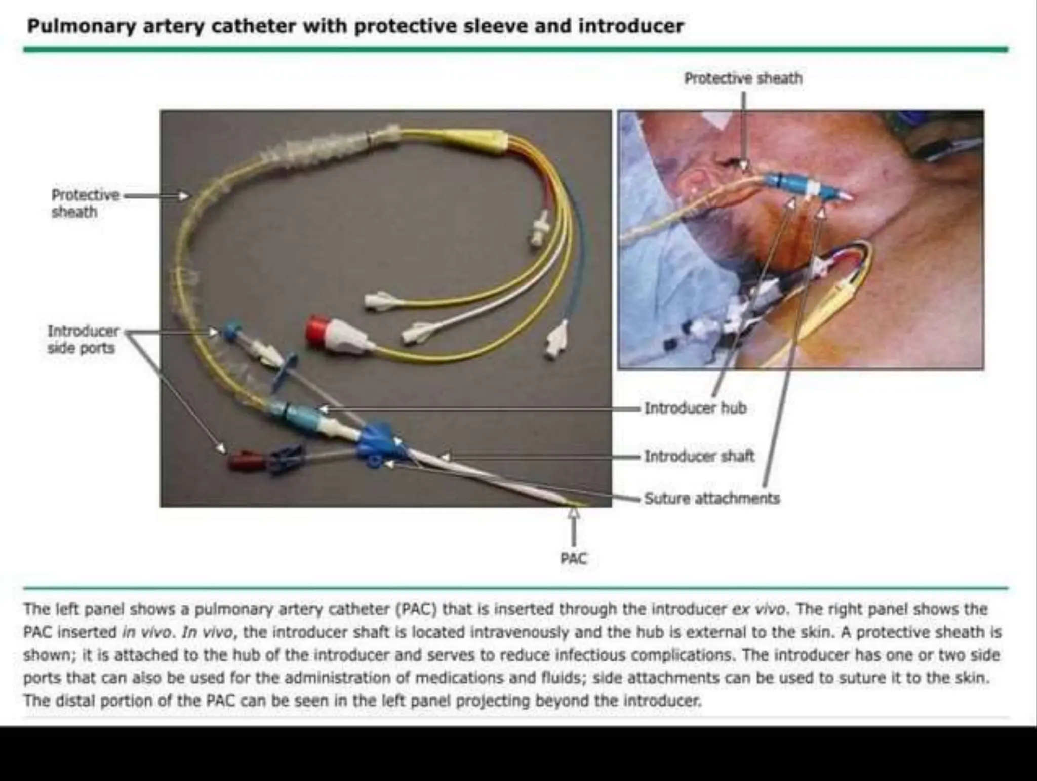 Pulmonary Artery Cathetrization by Dr. Animesh | PPT