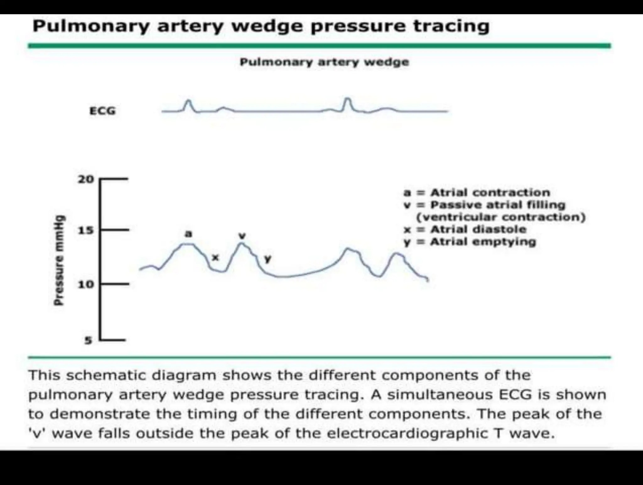 Pulmonary Artery Cathetrization by Dr. Animesh | PPT