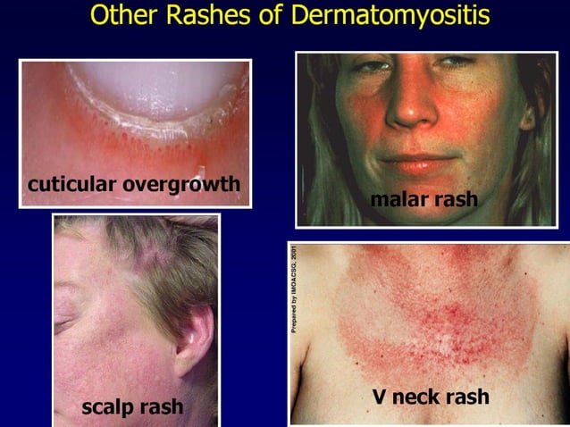 A Case of Dermatomyositis