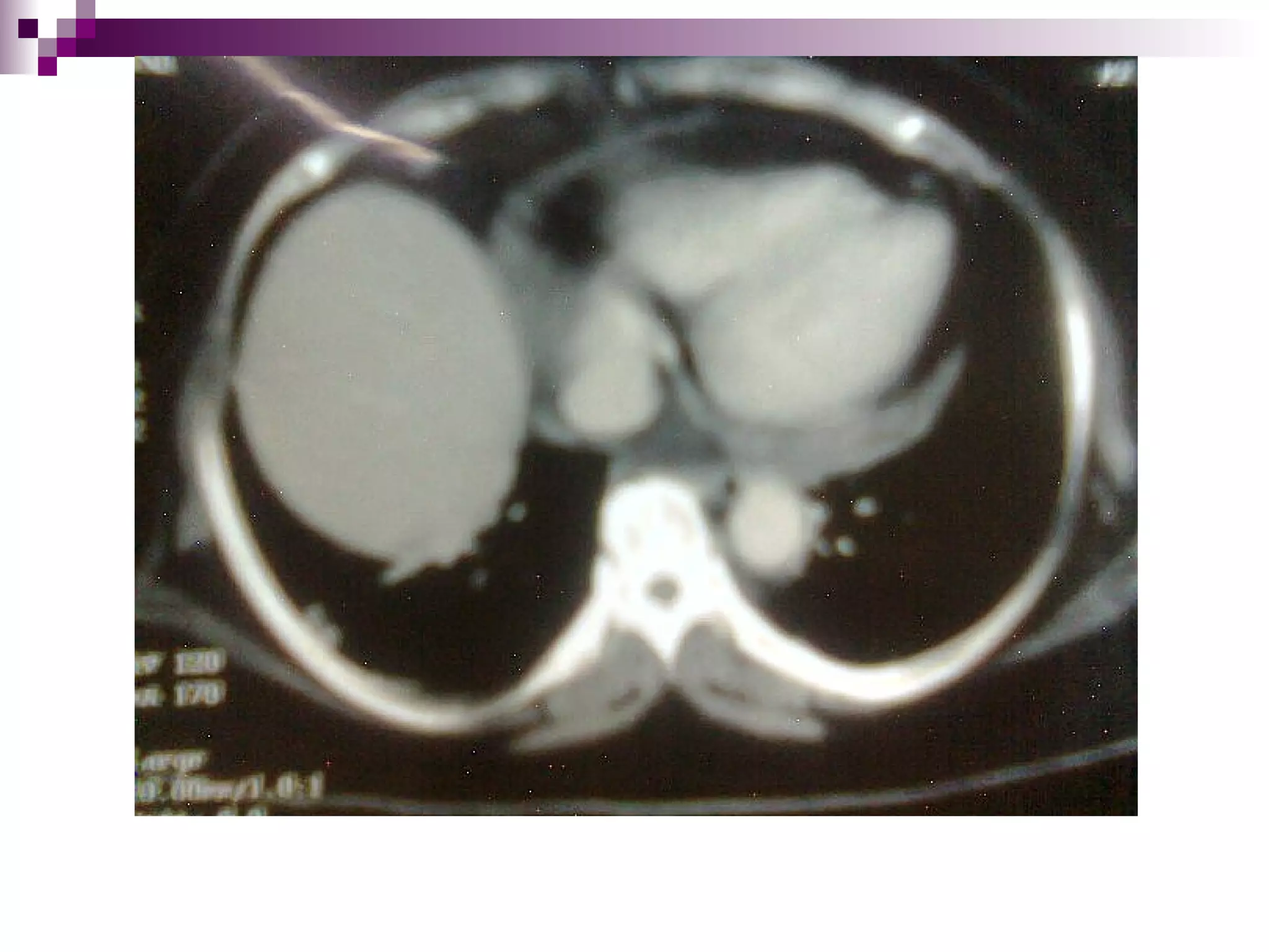 A case of SLE polyserositis & pneumonitis | PPT | Lung and Respiratory ...