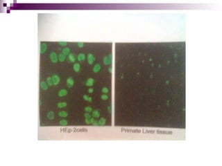 A case of SLE polyserositis & pneumonitis | PPT | Lung and Respiratory ...
