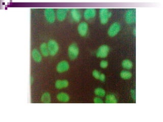 A case of SLE polyserositis & pneumonitis | PPT | Lung and Respiratory ...