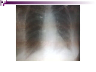 A case of SLE polyserositis & pneumonitis | PPT | Lung and Respiratory ...