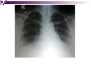 A case of SLE polyserositis & pneumonitis | PPT | Lung and Respiratory ...