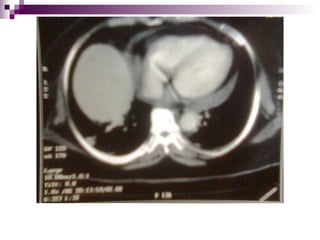A case of SLE polyserositis & pneumonitis | PPT | Lung and Respiratory ...
