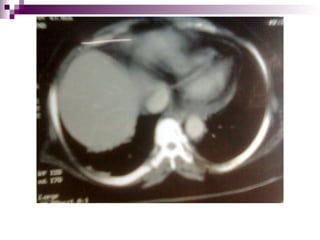A case of SLE polyserositis & pneumonitis | PPT | Lung and Respiratory ...