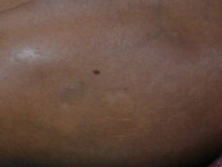 A Case of Pyomyositis | PPT