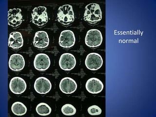 An interesting fever | PPTX