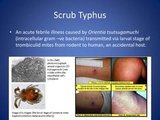 An interesting fever | PPTX