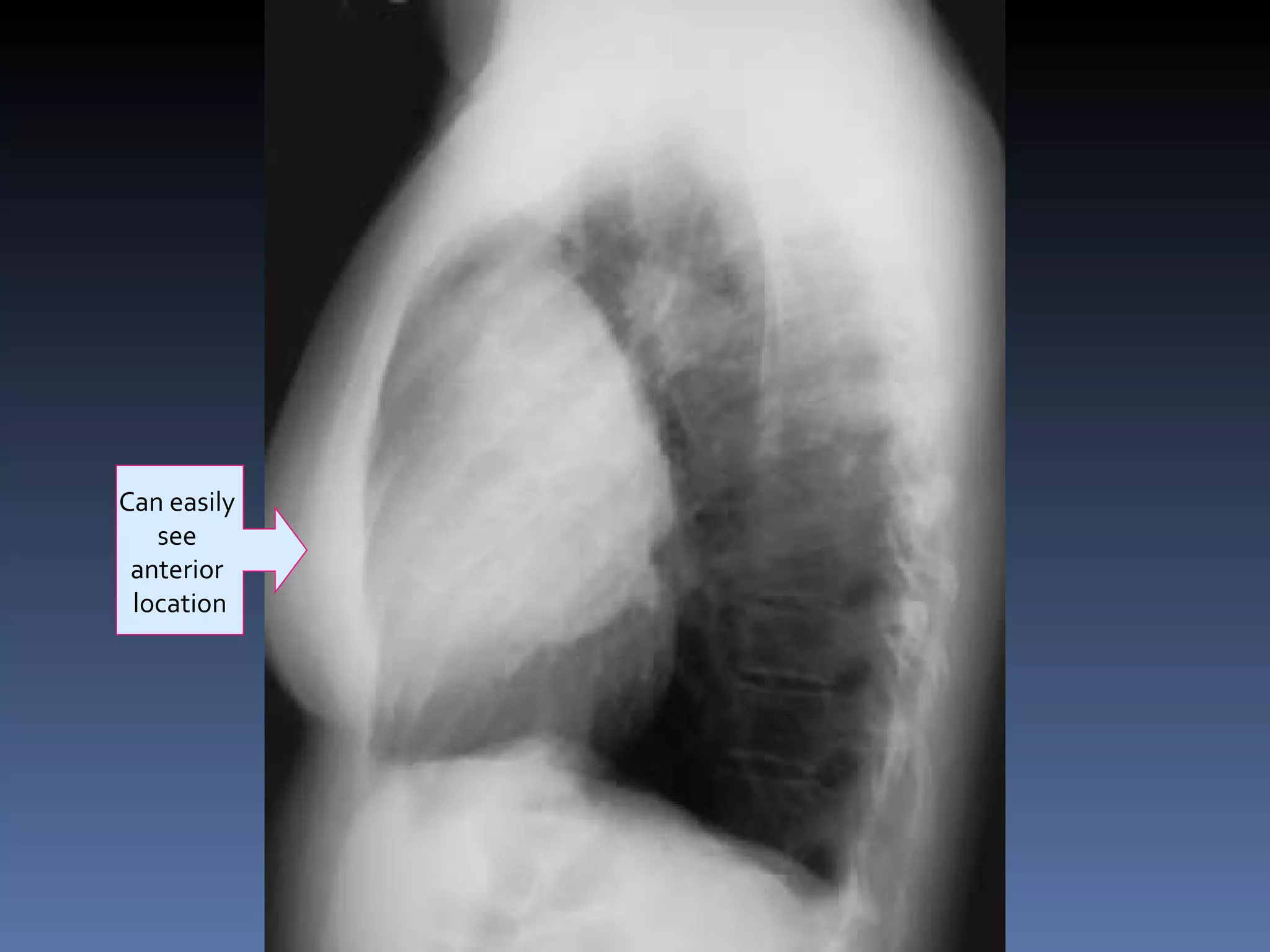 CXR: Lung Mass - Mediastinal Mass | PPT