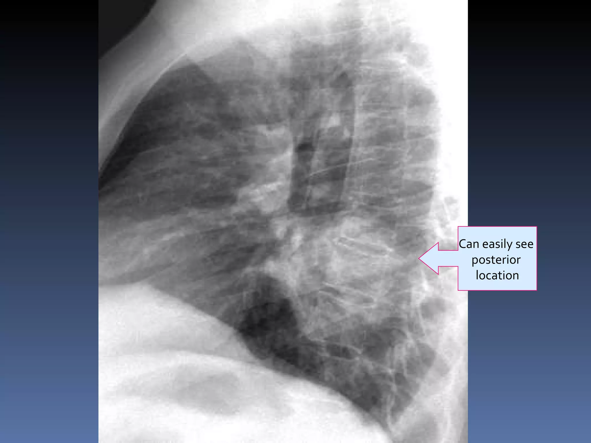 CXR: Lung Mass - Mediastinal Mass | PPT