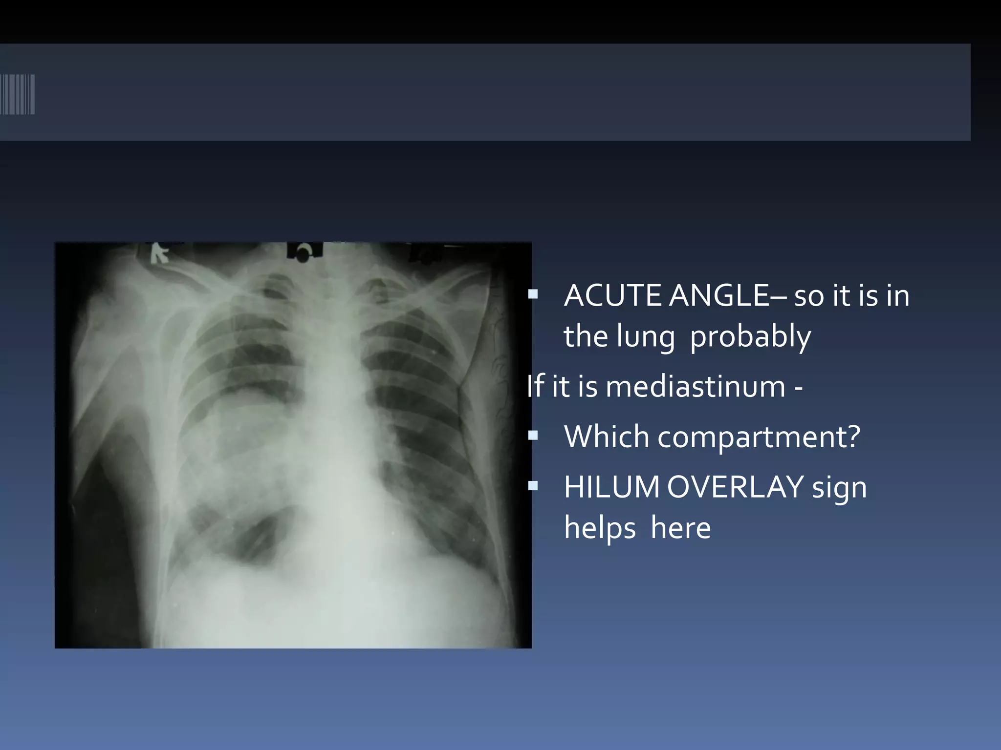 CXR: Lung Mass - Mediastinal Mass | PPT