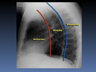CXR: Lung Mass - Mediastinal Mass | PPT