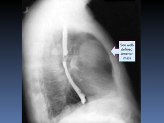 CXR: Lung Mass - Mediastinal Mass | PPT