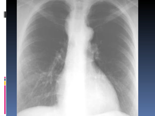CXR: Lung Mass - Mediastinal Mass | PPT