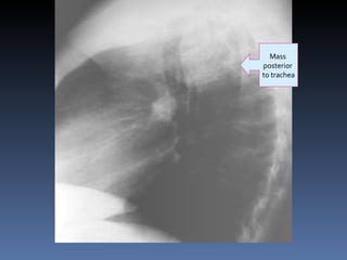 CXR: Lung Mass - Mediastinal Mass | PPT