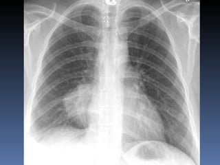 CXR: Lung Mass - Mediastinal Mass | PPT