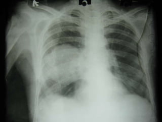 CXR: Lung Mass - Mediastinal Mass | PPT