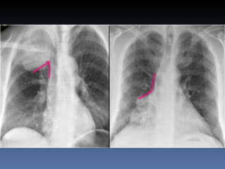 CXR: Lung Mass - Mediastinal Mass | PPT