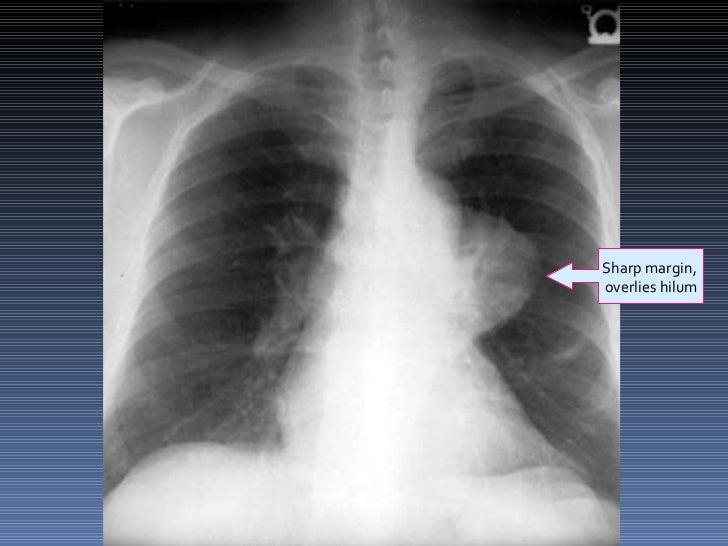 Cxr Lung Mass Mediastinal Mass