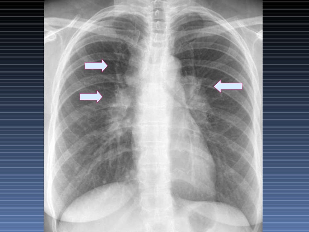 Cxr Lung Mass Mediastinal Mass