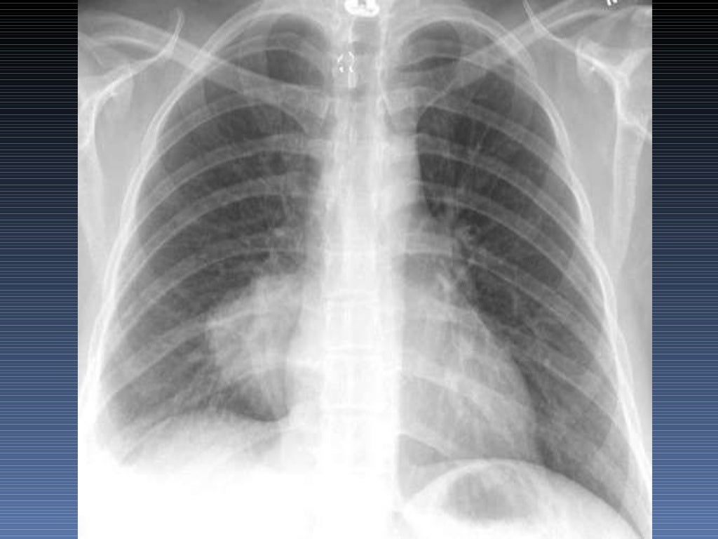 Cxr Lung Mass Mediastinal Mass