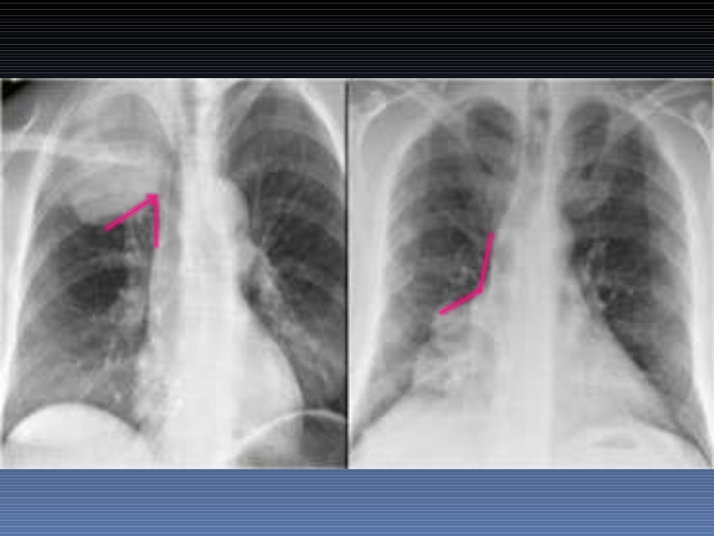CXR: Lung Mass - Mediastinal Mass