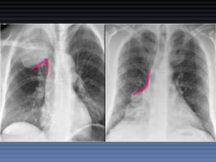 Cxr Lung Mass Mediastinal Mass