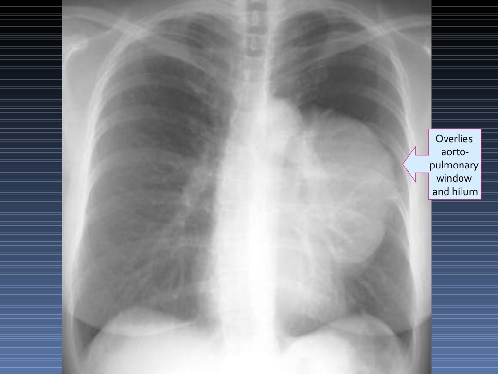 CXR: Lung Mass - Mediastinal Mass