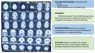 An intresting case of tremor , rubral tremor | PPT