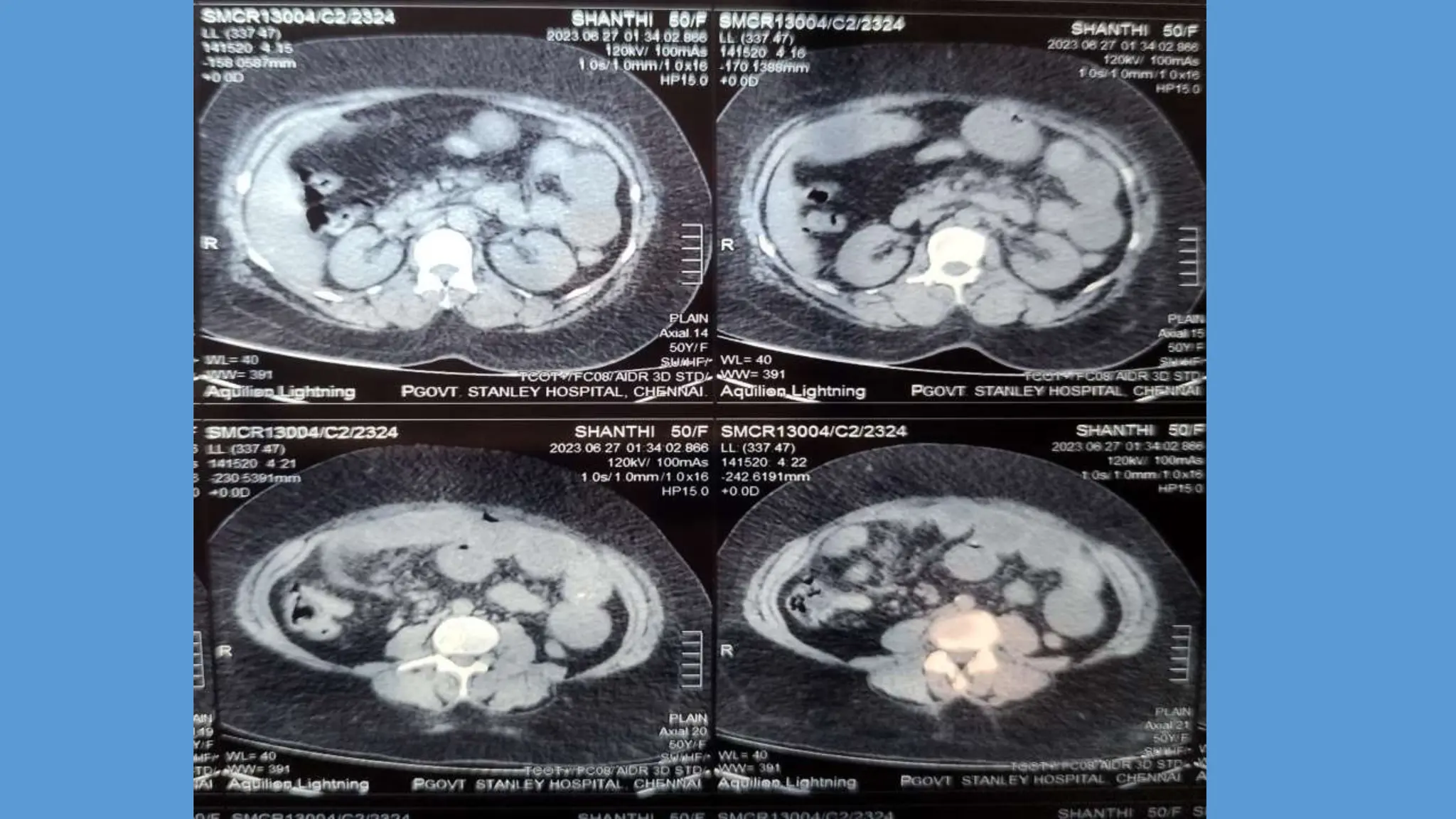 AN INTRIGUING CASE SERIES ON INTESTINAL OBSTRUCTION IN TB ABDOMEN FINAL ...
