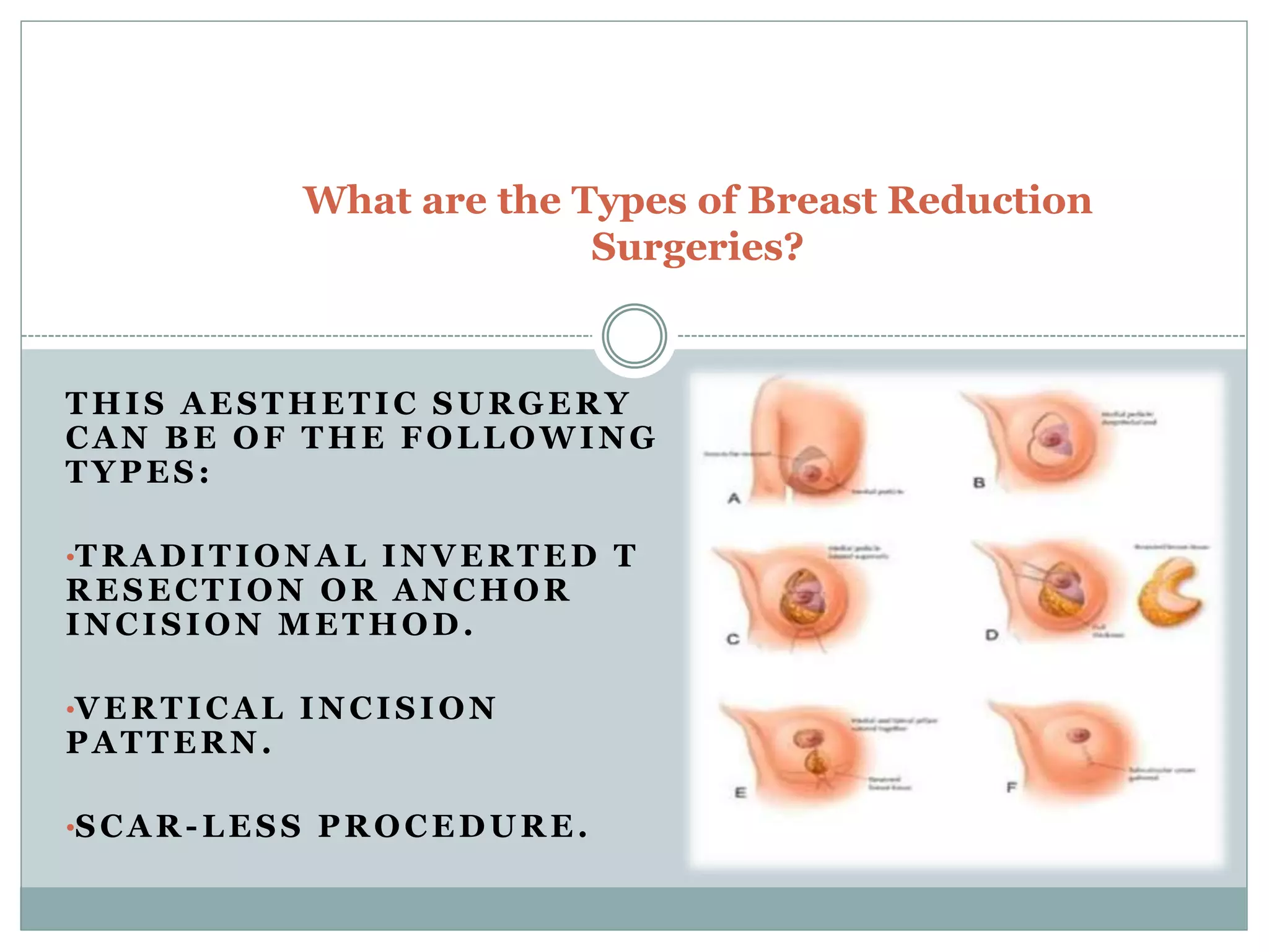 Know Everything About Breast Reduction | PPTX