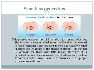 Know Everything About Breast Reduction | PPTX