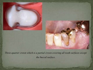 An Introduction to Fixed Prosthodontics dr. wasan.pptx