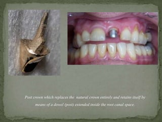 An Introduction to Fixed Prosthodontics dr. wasan.pptx